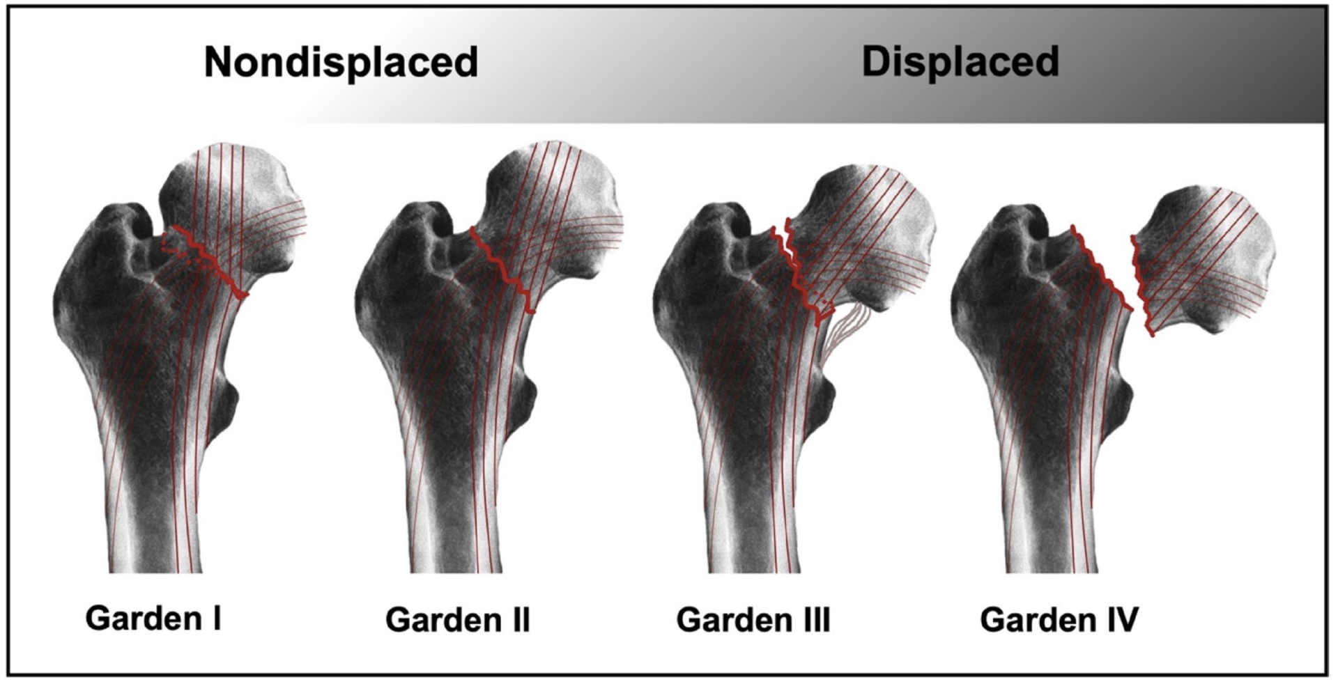 大腿骨頚部骨折の分類について（ガイドラインより, 2021年） | 大腿骨頚部骨折からスキー復帰まで