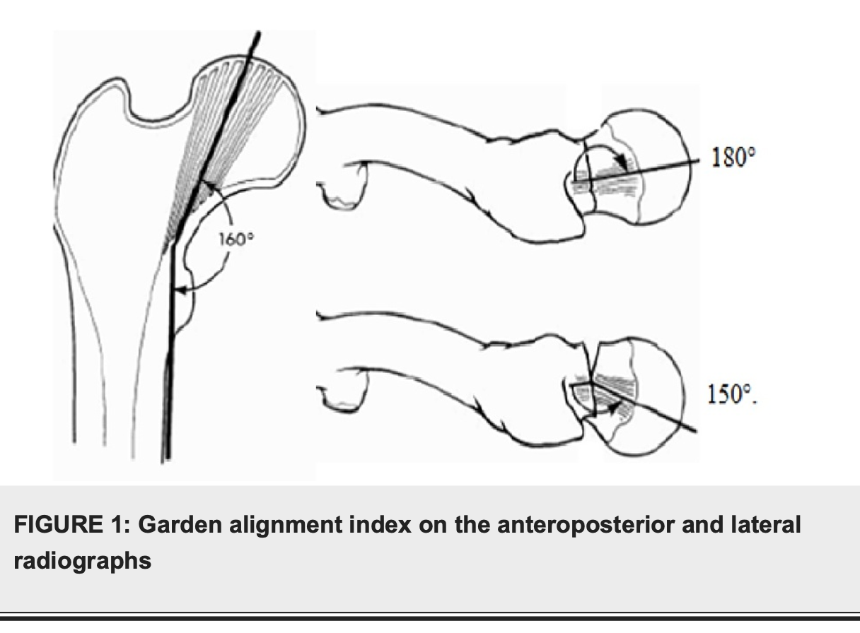 大腿骨頚部骨折後の整復位の指標（Garden alignment index）とはなんでしょうか？（原著論文より, 1971年） | 大腿骨 ...