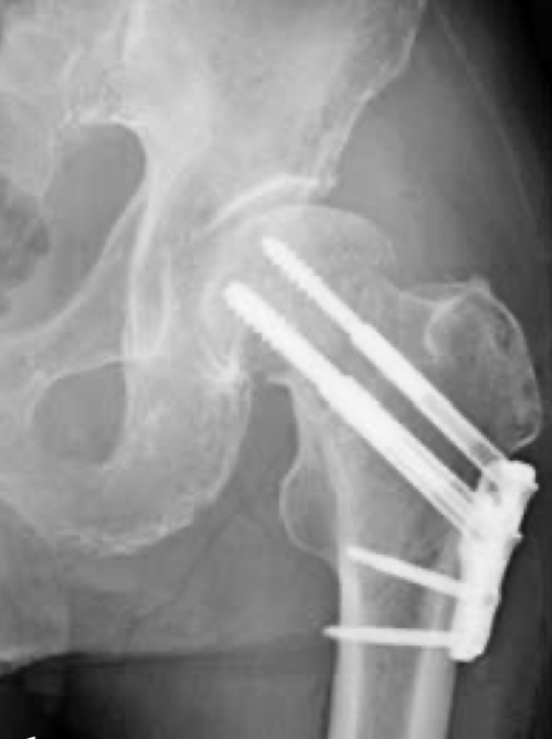 大腿骨頚部骨折を固定する手術では, どの器械を使うのがよいでしょうか？ 内固定器械による差異 | 大腿骨頚部骨折からスキー復帰まで