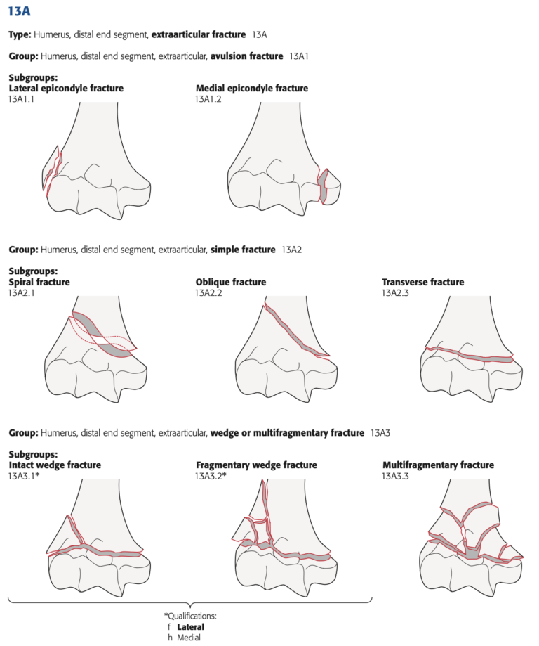 整形外科医がスキーでの大腿骨頚部骨折の手術後275日目のブログ | 大腿骨頚部骨折からスキー復帰まで